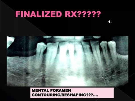 Case Ppt Mental Nerve Neuralgia Pptx Brain And Nervous System Disorders Diseases And