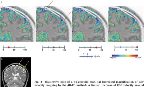 Figure From The Choroid Plexus Of The Lateral Ventricle As The Origin Of CSF Pulsation Is
