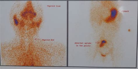 Thyroid Scan Showing No Uptake In The Thyroid Gland But Increased Download Scientific Diagram