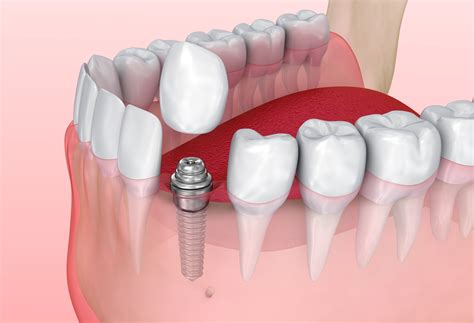 Implant Supported Crowns Albuquerque Nm Dr James Slaman Dds Pc