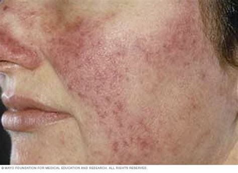 Dr Beals Faad Mohs Surgery Dermatology Clinics In Niceville And Andalusia Dr Beals Faad Mohs Surgery Dermatology Clinics In Niceville And Andalusia