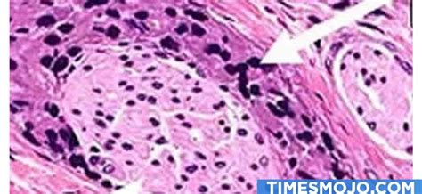 How Serious Is Perineural Invasion Timesmojo