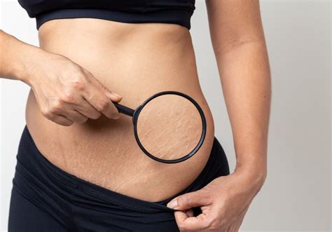 Stretch Mark Treatments Collagen Skin Renewal