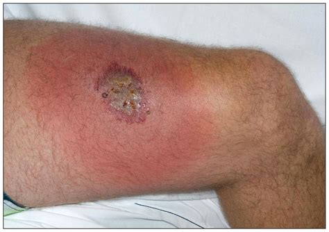 Erythema Migrans Vs Erythema Multiforme