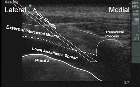 Paravertebral Block Trunk Block Thoracic Paravertebral Nerve Block