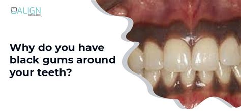 What Causes The Presence Of Dark Gums Around Your Teeth By Align