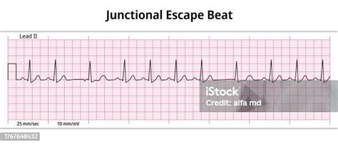 Ecg Junctional Escape Beat Kertas Ekg 8 Detik Ilustrasi Stok Unduh