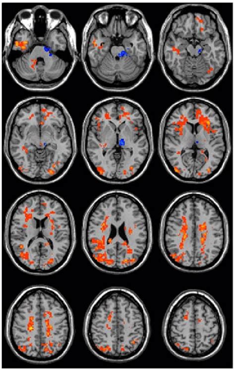 Brain Areas With An Abnormal Amplitude Of Low Frequency Fluctuation Download Scientific Diagram