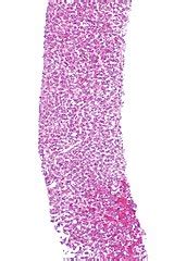 Low Grade Oncocytic Renal Tumour Libre Pathology