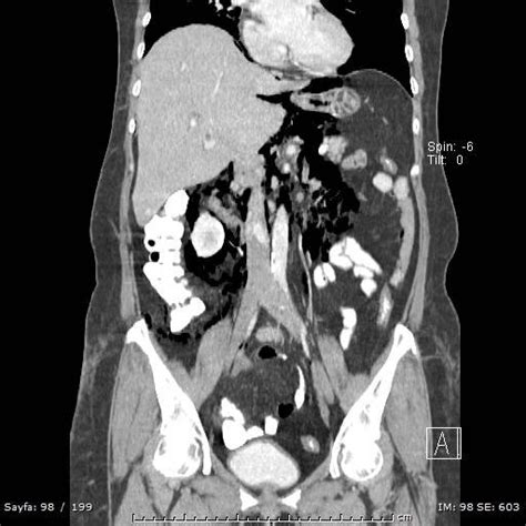 DBE And SBE Learning Curve Of Roux En Y ERCP Download Scientific Diagram