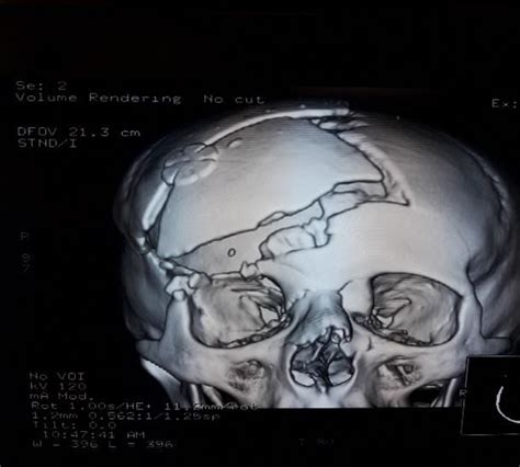 Figure 1 From Comminuted Expressed Depressed Skull Fracture Semantic Scholar