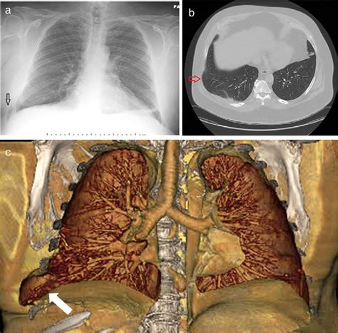 Spontaneous Lung Hernia Secondary To Persistent Cough A Rare Entity