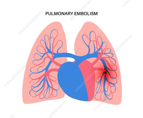 Pulmonary Embolism Illustration Stock Image F036 6486 Science Photo Library