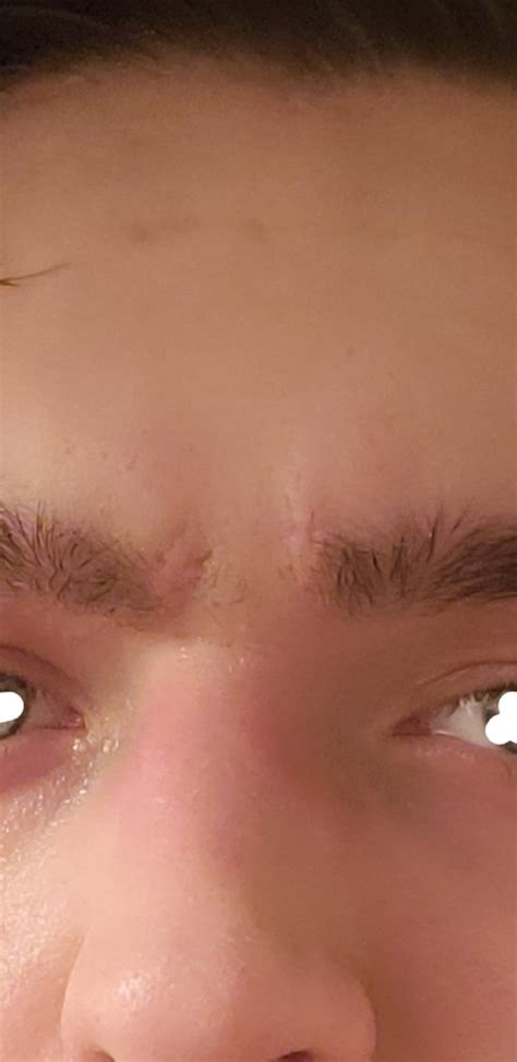 Scar Treatment Advice For Scars Between Eyebrows Acne Scars Acne