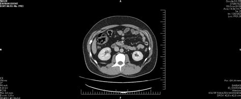 Appendicitis Detection Classification Dataset By Appendicitis Detection System