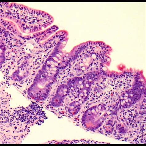 Severe Lymphoplasmacytic A Gastric Inflammation B Duodenal Download Scientific Diagram