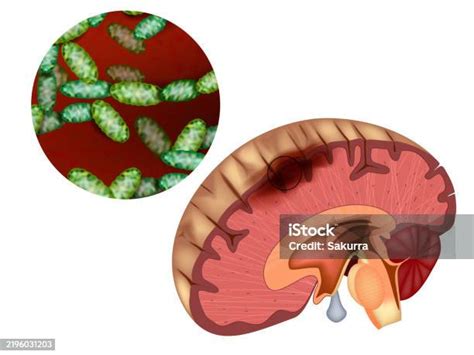 세균성 수막염 그림 뇌 감염 및 박테리아 의료 해부학 다이어그램 병원성 박테리아와의 뇌 단면 건강관리와 의술에 대한 스톡 벡터 아트 및 기타 이미지 Istock
