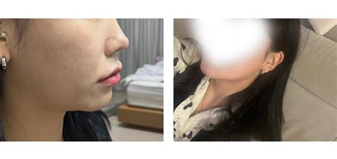 파워v얼굴지방흡입 실리프팅 후기 닥터정 리반의원 파워v얼굴지방흡입 실리프팅 후기 닥터정 리반의원