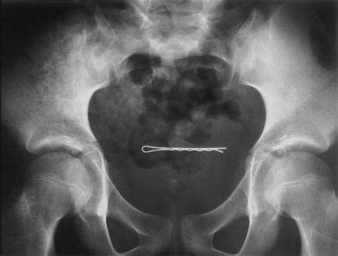 Photo Gallery Abdominal Pelvic And Rectal Foreign Bodies