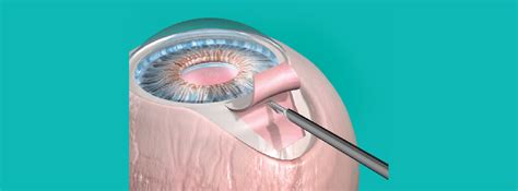 Glaucoma Surgery Types