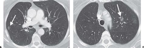 Neoplasms Of The Lung Radiology Key
