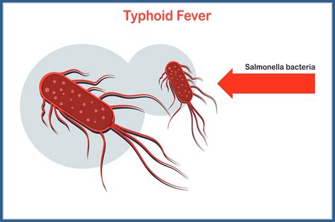 Understanding Typhoid Causes Symptoms Prevention And Treatment