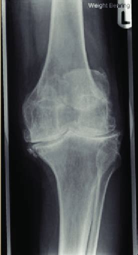 Kellgren Lawrence Kl Scale 4 In A Hemophilia A Patient On Ap X Ray Download Scientific Diagram