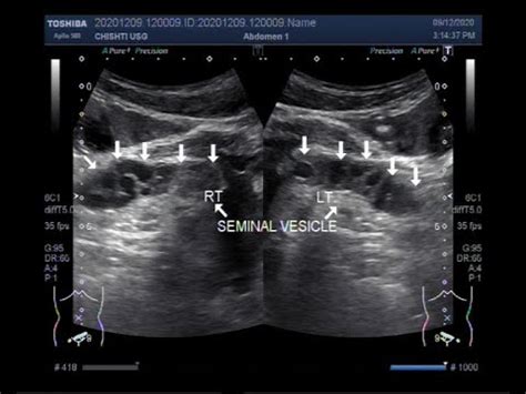 Ultrasound Video Showing Enlarged Seminal Vesicles Youtube