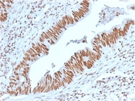 Nucleophosmin Acute Myeloid Leukemia Marker Monoclonal Antibody Npm1 3398 4869 Msm8 P0
