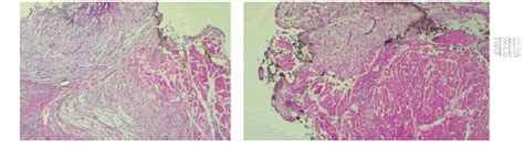 Malignant Phyllodes Tumour With Lymph Node Metastasis