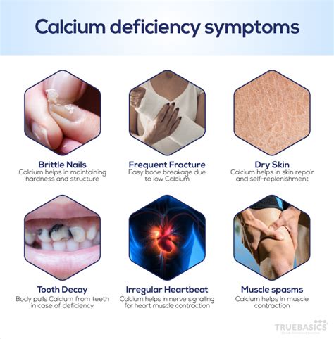 What Causes Calcium Deposits On Your Bones At Jack Marco Blog