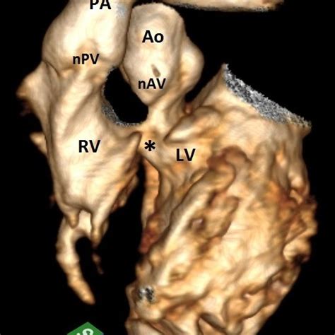 Pdf Late Complete Atrioventricular Block After Hybrid Perimembranous Ventricular Septal Defect