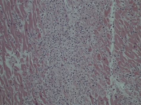 Fatal Autoimmune Myocarditis With Antipd L1 And Tyrosine Kinase Inhibitor Therapy For Renal