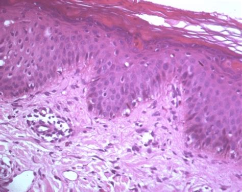 Histological Section Of The Skin Showing Necrotic Keratinocytes And A