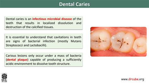 Solution Operative4 Lec 6 Management Of Dental Caries In Enamel And Dentin Classification