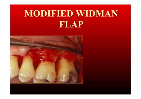 Modified Widman Flap Pdf