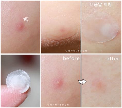 여드름 패치 붙여 뾰루지 가라앉히기 얇은 닥터원더 원더패치 스티커 네이버 블로그