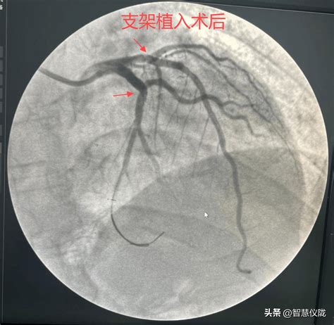 仪陇县总医院马鞍院区成功自主开展冠状动脉造影及支架植入术患者手术心脏