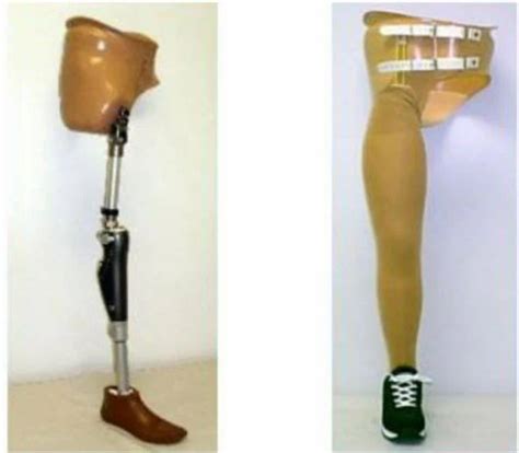Hip Disarticulation Prostheses At ₹ 110000piece Bipolar Prosthesis