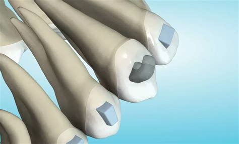 Spark Approver Release 13 New Innovative Features Ormco