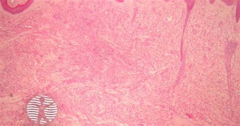 Pecoma Pathology Image