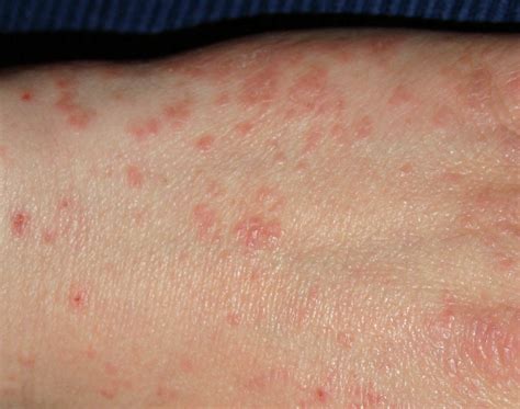 My Atypical Scabies Symptoms Unusual Signs Of Mites That Doctors Dont