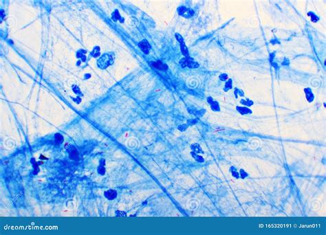 Mycobacterium Tuberculosis Positive In Sputum Smear Stock Image Image