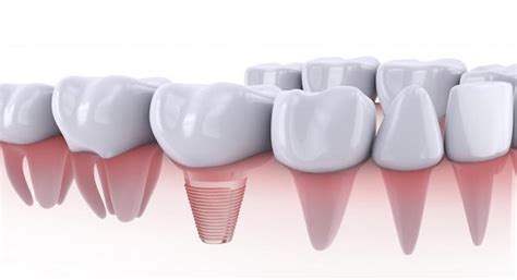 Why Consider Dental Implants Over Dentures Bondi Dental