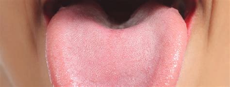 ¿cuáles Son Las Enfermedades Más Comunes De La Lengua Clínicas Dentales Dentalfit