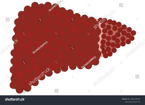 Liver Cirrhosis Disease Human Liver Organ Stock Vector Royalty Free