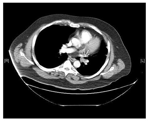 Computed Tomography Image Showing A 1 4 Cm Soft Tissue Nodular Density Download Scientific