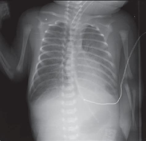 Figure 1 From Extralobar Pulmonary Sequestration As A Cause Of Recurrent Pulmonary Hemorrhage In