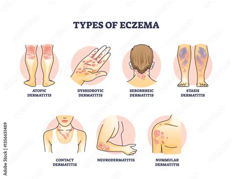 Eczema Types Diagram Shows Atopic Dyshidrotic And Seborrheic