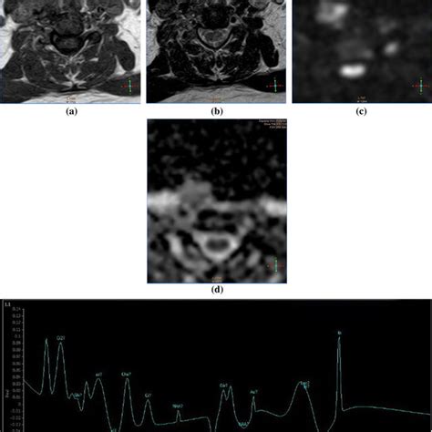 Roc Curve Of Adc Values For The Differentiation Of Benign From Download Scientific Diagram